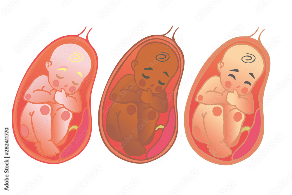 Fetal icon of different races, prenatal human child with placenta ...