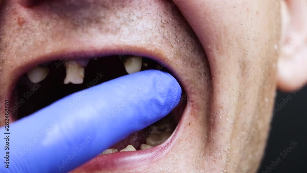 The man has rotten teeth, teeth fell out, yellow and black teeth hurt ...