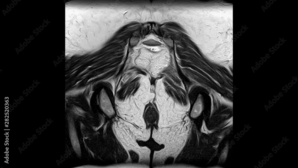 Contrast MRI scan of the abdominal cavity and retroperitoneal space ...