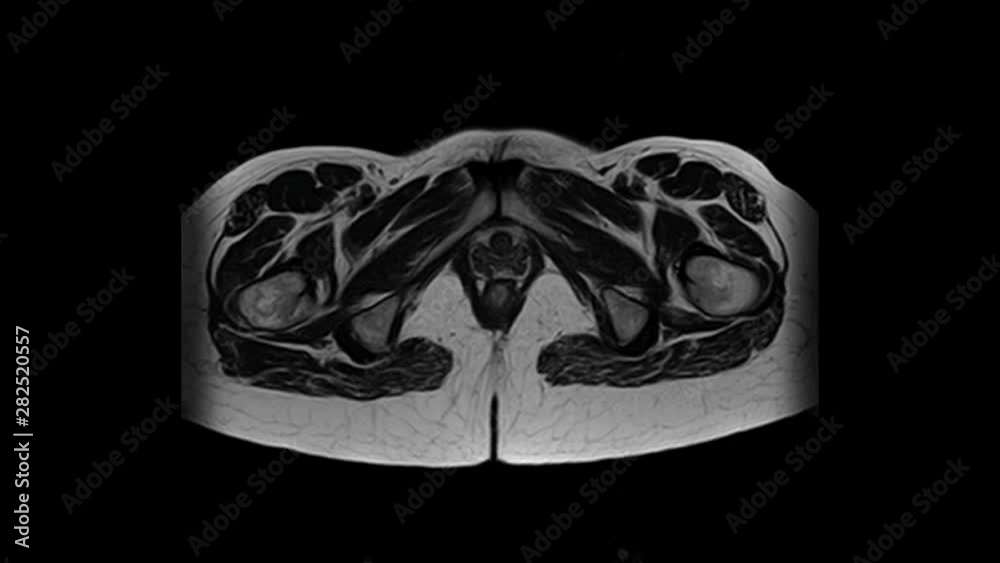Contrast MRI scan of the abdominal cavity and retroperitoneal space ...
