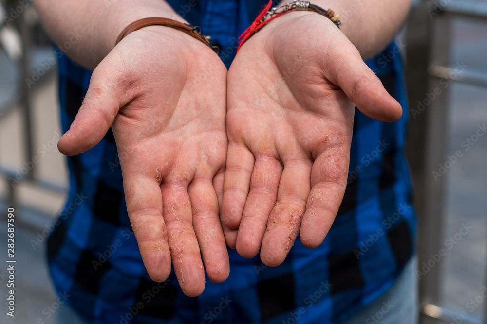 Dyshidrotic eczema, hands of patient. Concept of health care Stock ...