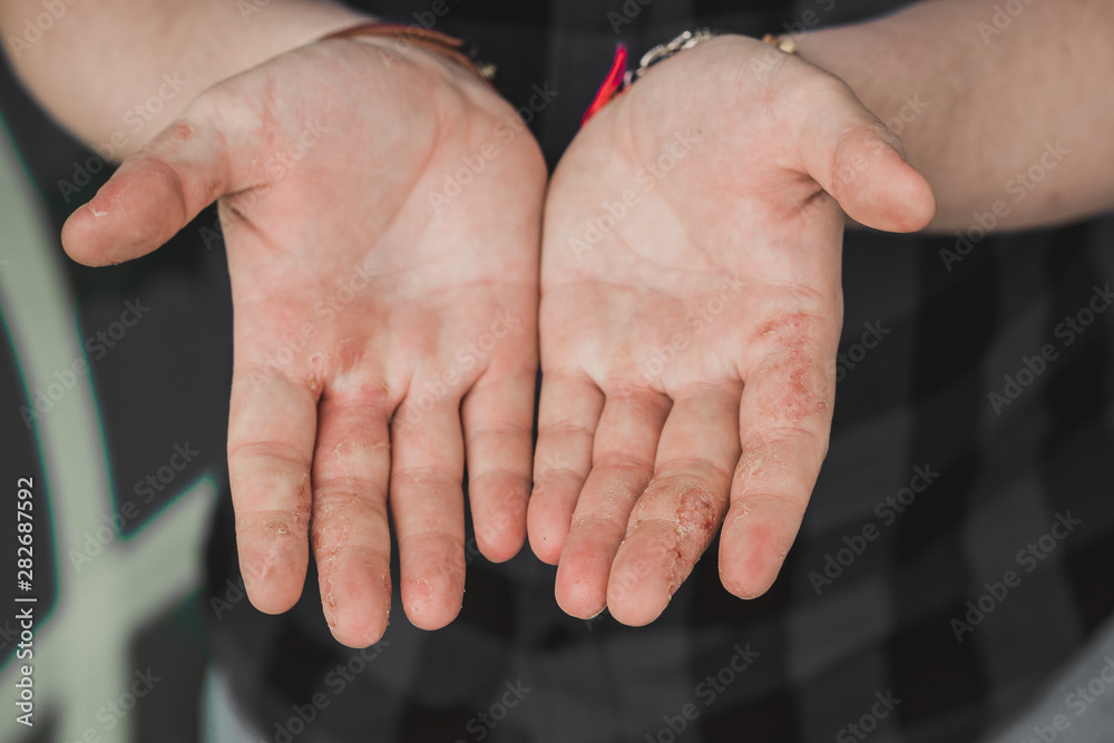 Dyshidrotic eczema, hands of patient. Concept of health care Stock ...
