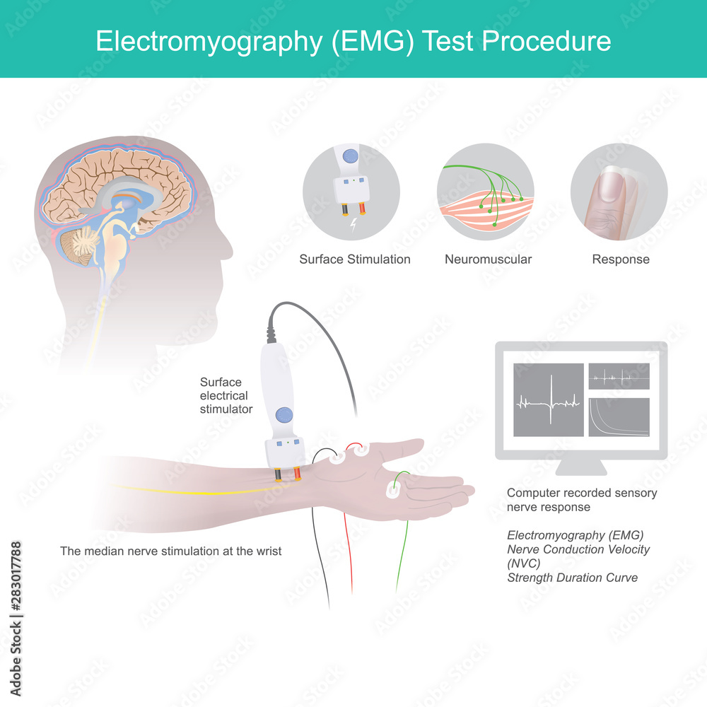 Electromyography Test Procedure. Stock Vector | Adobe Stock