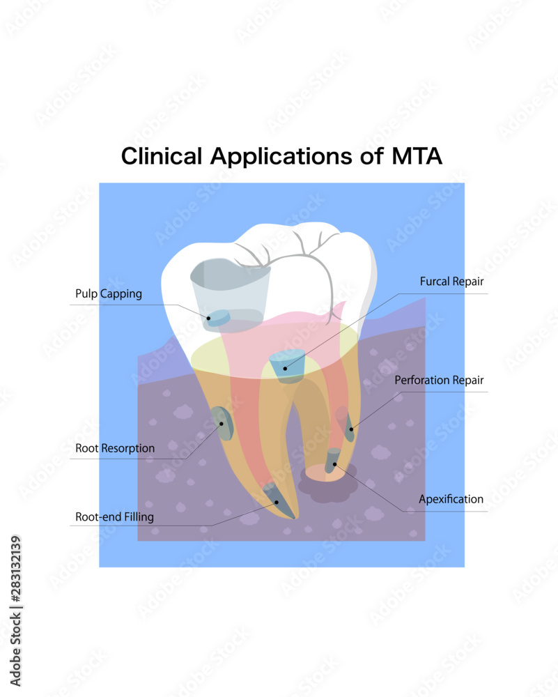 Vetor de 歯科MTA do Stock | Adobe Stock