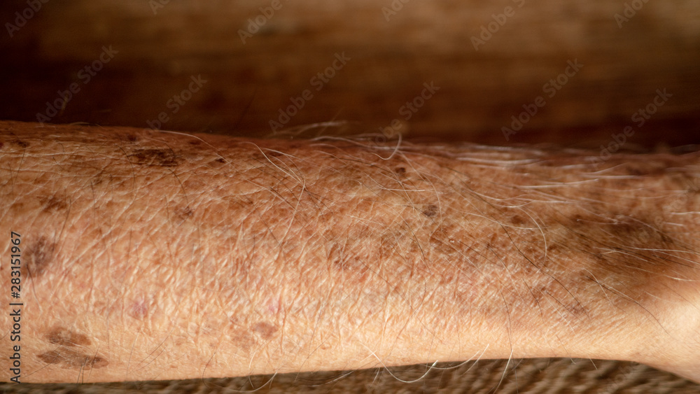Old man's arm have discoloration of the skin, have freckles. Stock ...