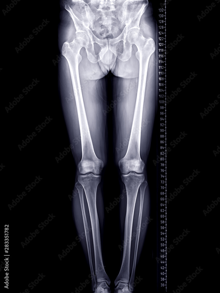 scanogram of lower limb or X-ray image of total lower extremity with ...