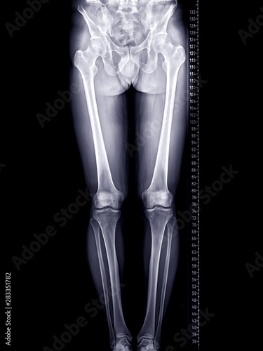 scanogram of lower limb or X-ray image of total lower extremity with ...