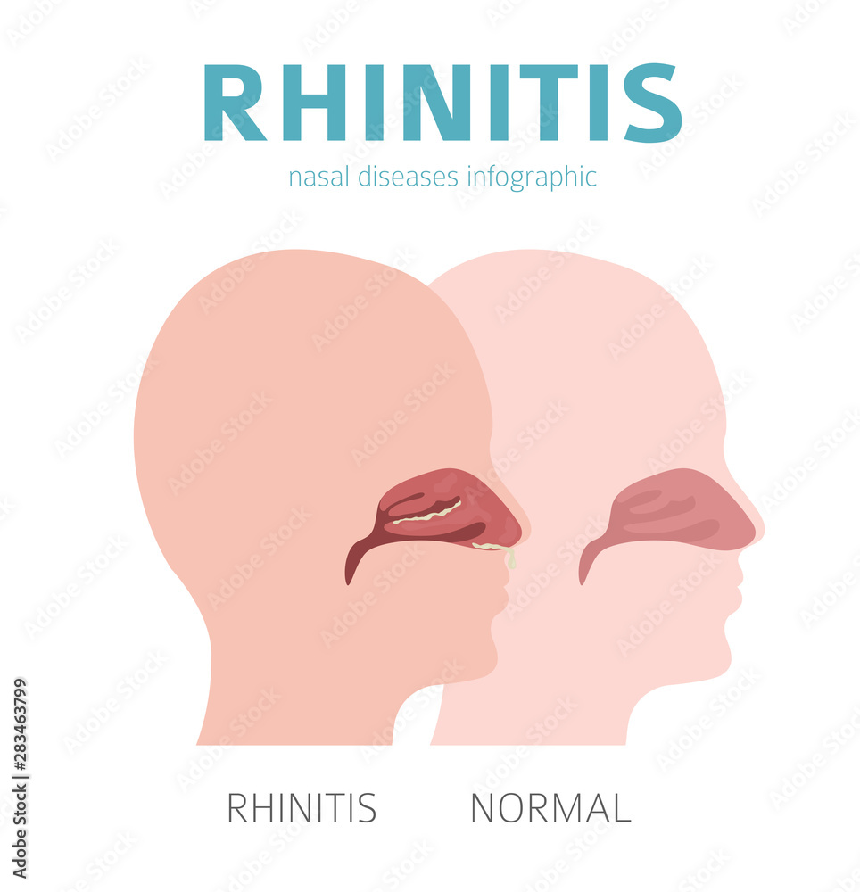 Nasal diseases. Rhinitis symptoms, treatment icon set. Medical ...