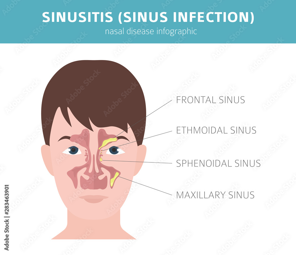 Nasal diseases. Sinusitis, sinus infection diagnosis and treatment ...