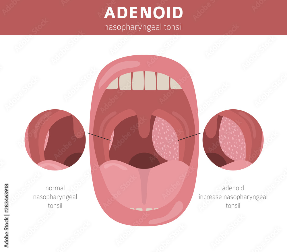 Nasal and throat, nasopharynx diseases. Adenoids diagnosis and ...