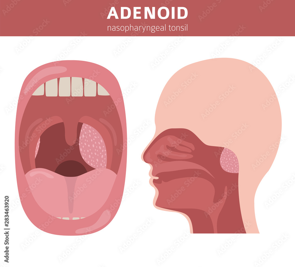 Nasal and throat, nasopharynx diseases. Adenoids diagnosis and ...