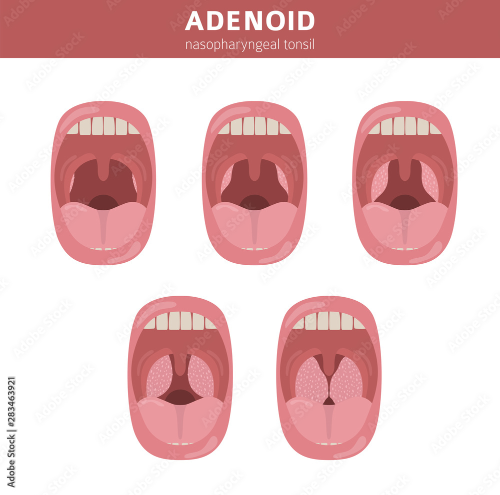 Nasal and throat, nasopharynx diseases. Adenoids diagnosis and ...