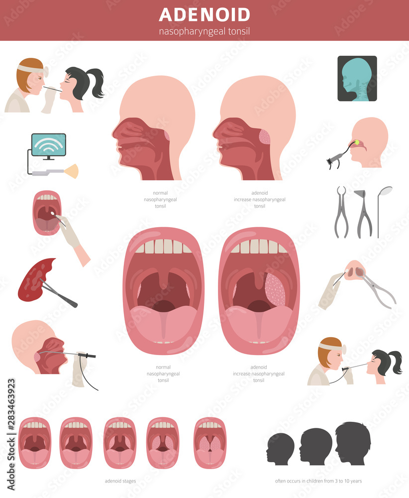 Nasal and throat, nasopharynx diseases. Adenoids diagnosis and ...
