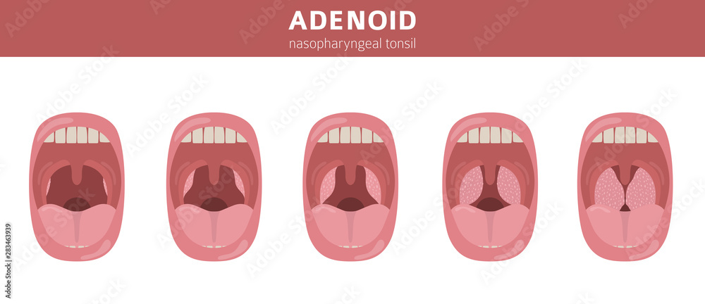 Nasal and throat, nasopharynx diseases. Adenoids diagnosis and ...