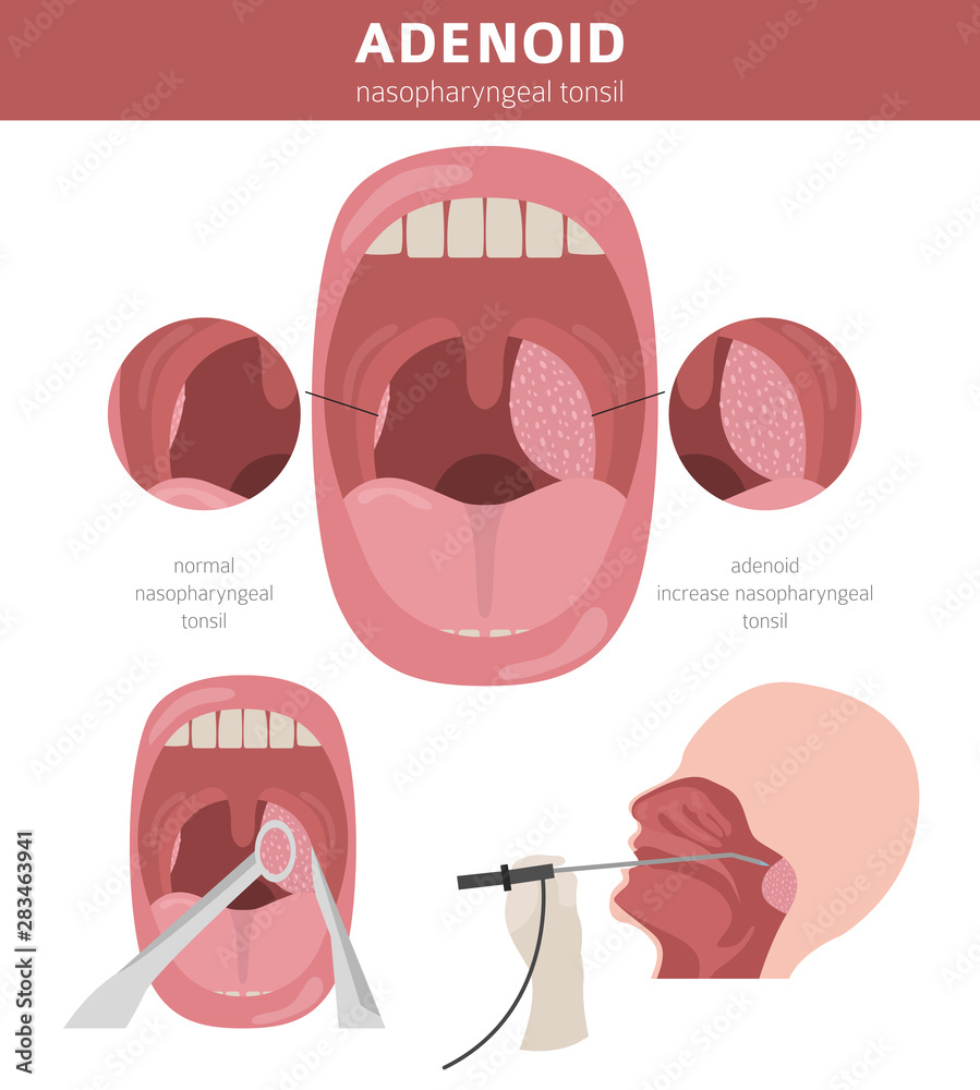 Nasal and throat, nasopharynx diseases. Adenoids diagnosis and ...