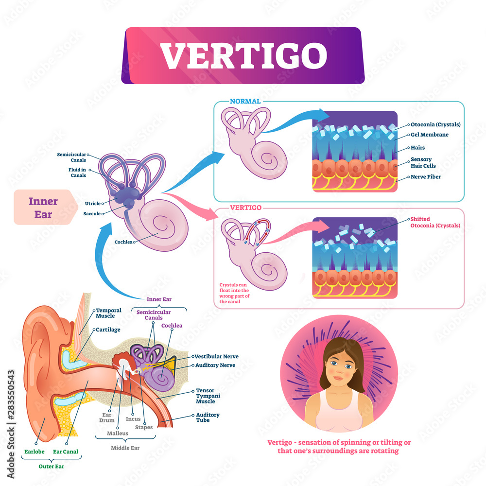 Vertigo vector illustration. Labeled medical vestibular ear problem ...