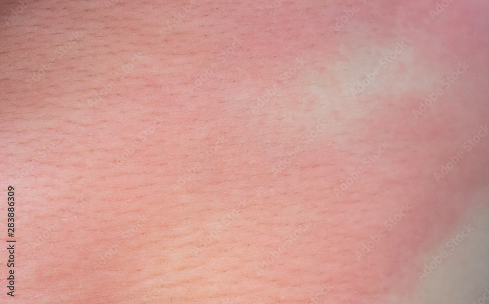 Severe eczema skin rash and allergic reaction symtom at little asian ...