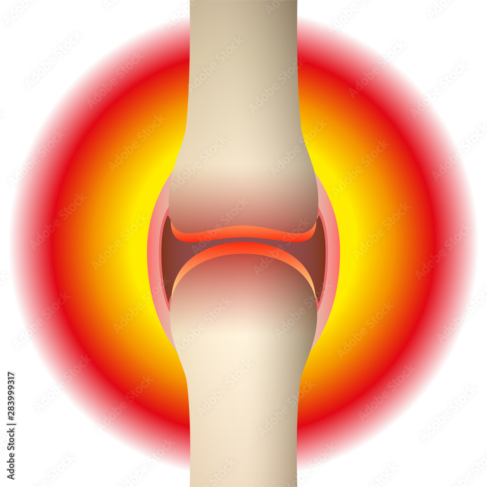 Joint pain - schematic anatomical graphic of a synovial joint with ...