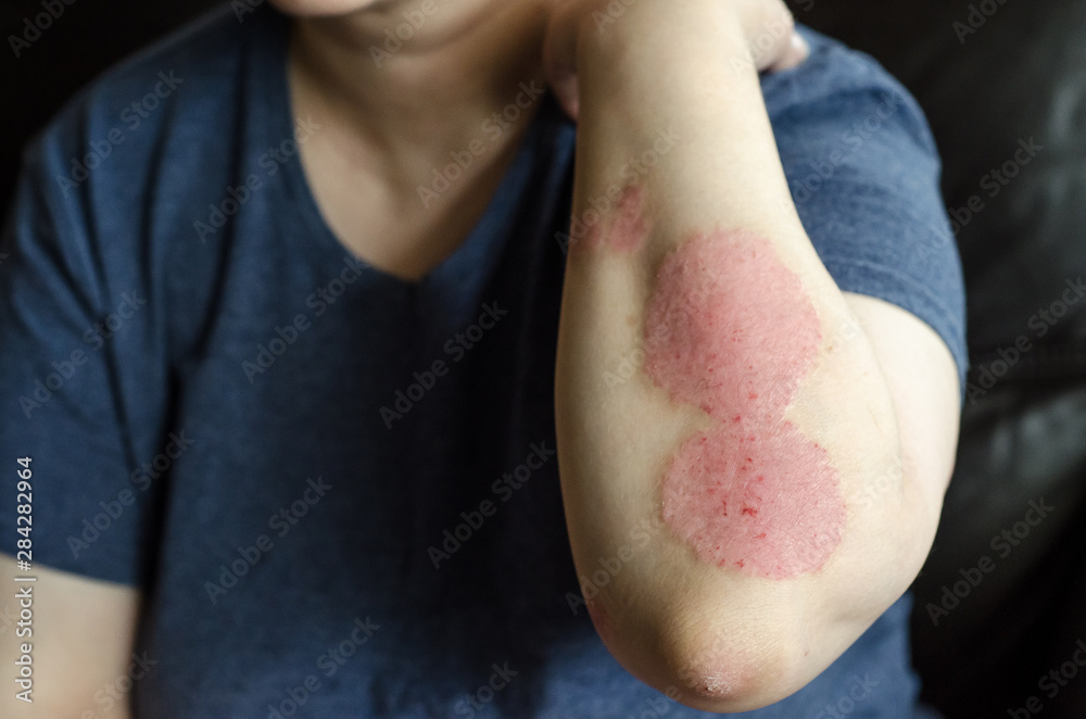 Dermatological skin disease. psoriasis, eczema, dermatitis, allergies ...