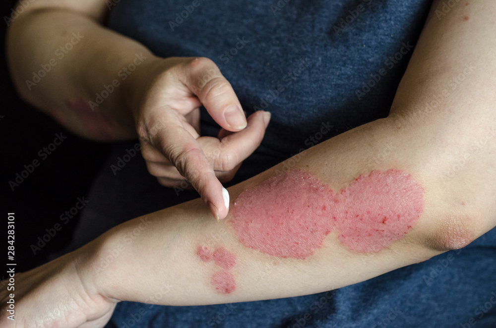 Dermatological skin disease. psoriasis, eczema, dermatitis, allergies ...