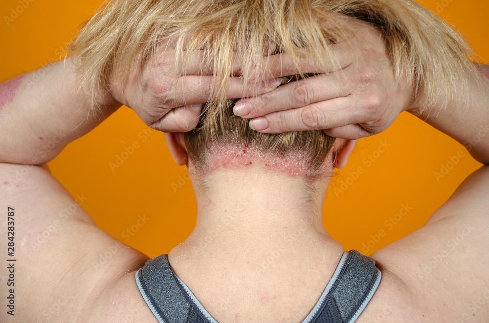 Dermatological skin disease. psoriasis, eczema, dermatitis, allergies ...