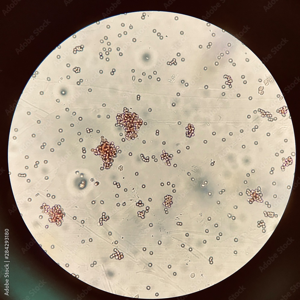 Red blood cells agglutination in crossmatching test incompatible ...