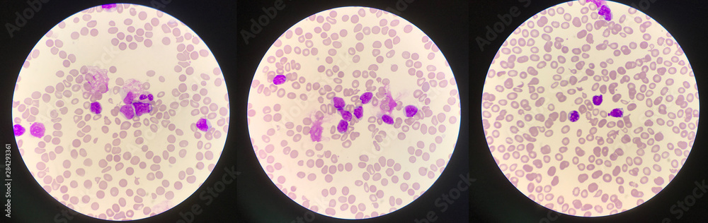 Immature white blood cells in leukemia. Foto Stok | Adobe Stock