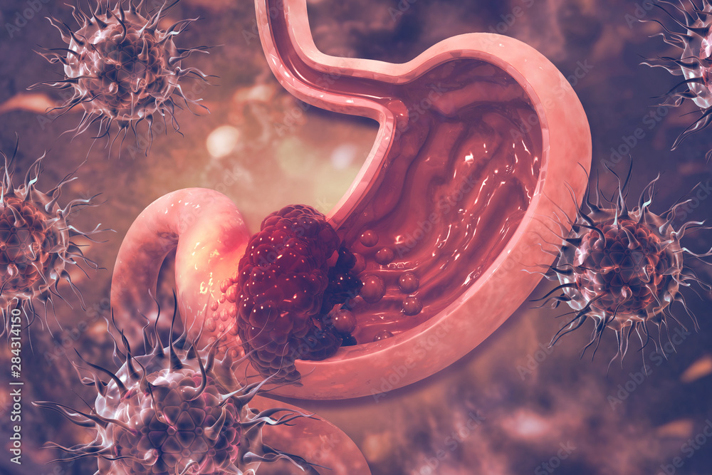 Stomach cancer. Cancer attacking cell. Stomach disease concept Stock ...