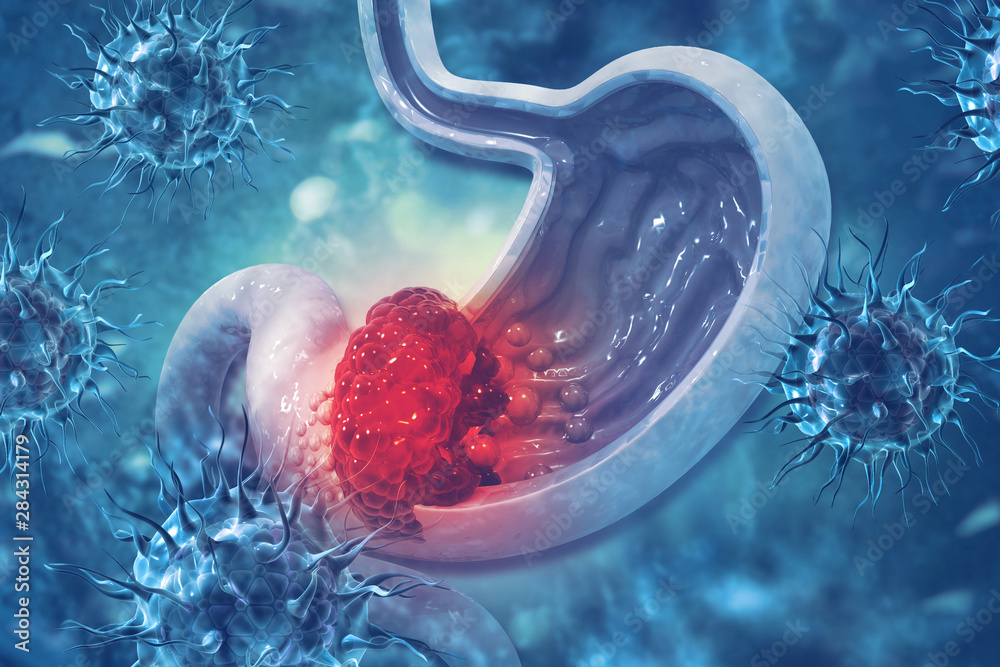 Stomach cancer. Cancer attacking cell. Stomach disease concept Stock ...