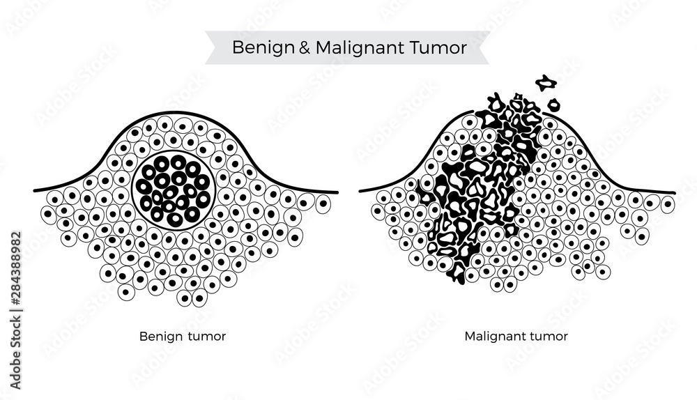 Vector illustration of malignant and benign tumor Stock Vector | Adobe ...