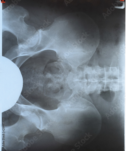X-ray of the pelvis and sacrum. X-ray Stock Photo | Adobe Stock