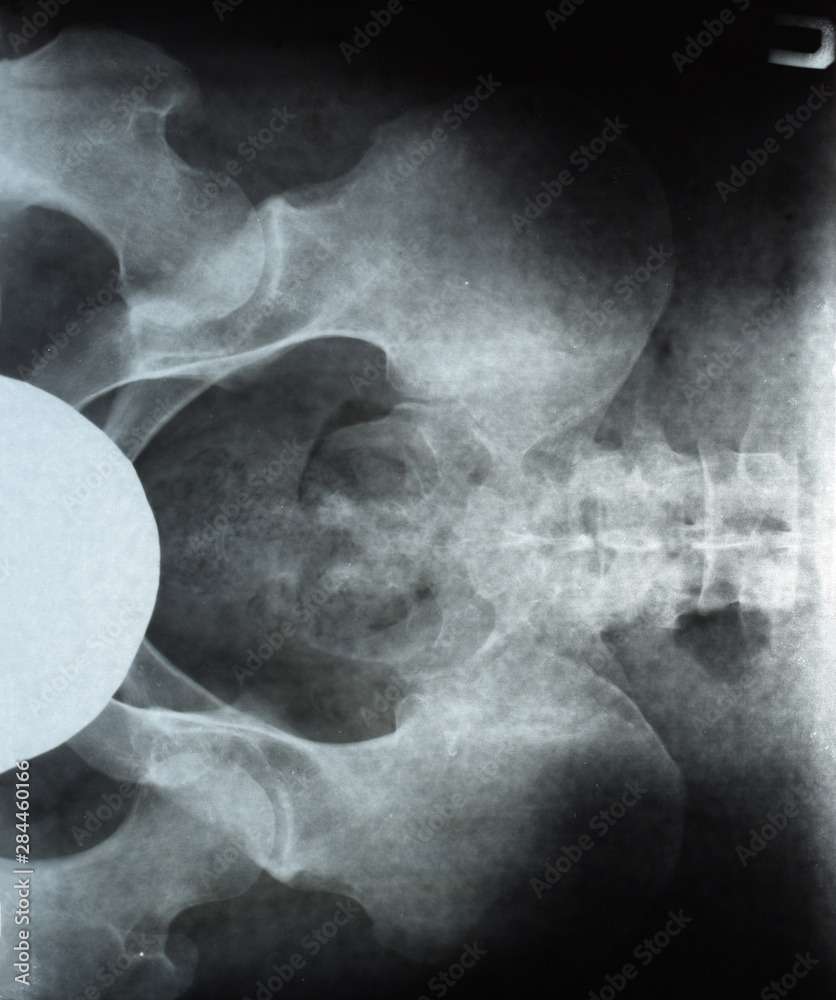 X-ray of the pelvis and sacrum. X-ray Stock Photo | Adobe Stock