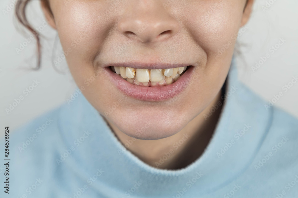 Problem teeth at the young girl. A curve row and the wrong bite an ...