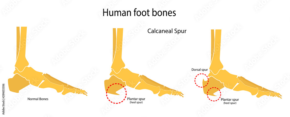Human foot bones. Plantar and dorsal spur (calcaneal spur ...