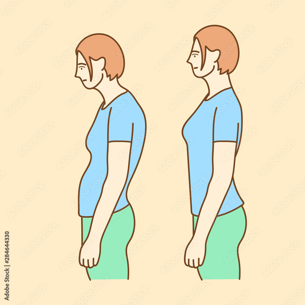 Impaired posture position defect scoliosis and ideal bearing. Stock ...