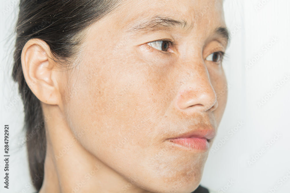 Dark spots on face woman and skin problems Facial Treatment Stock Photo ...