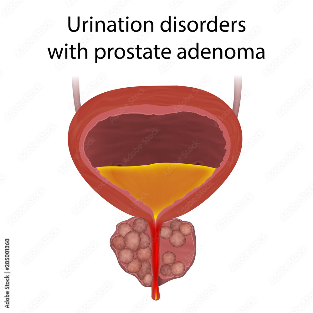 Urinary disorders with Adenoma of prostate gland. Realistic vector ...