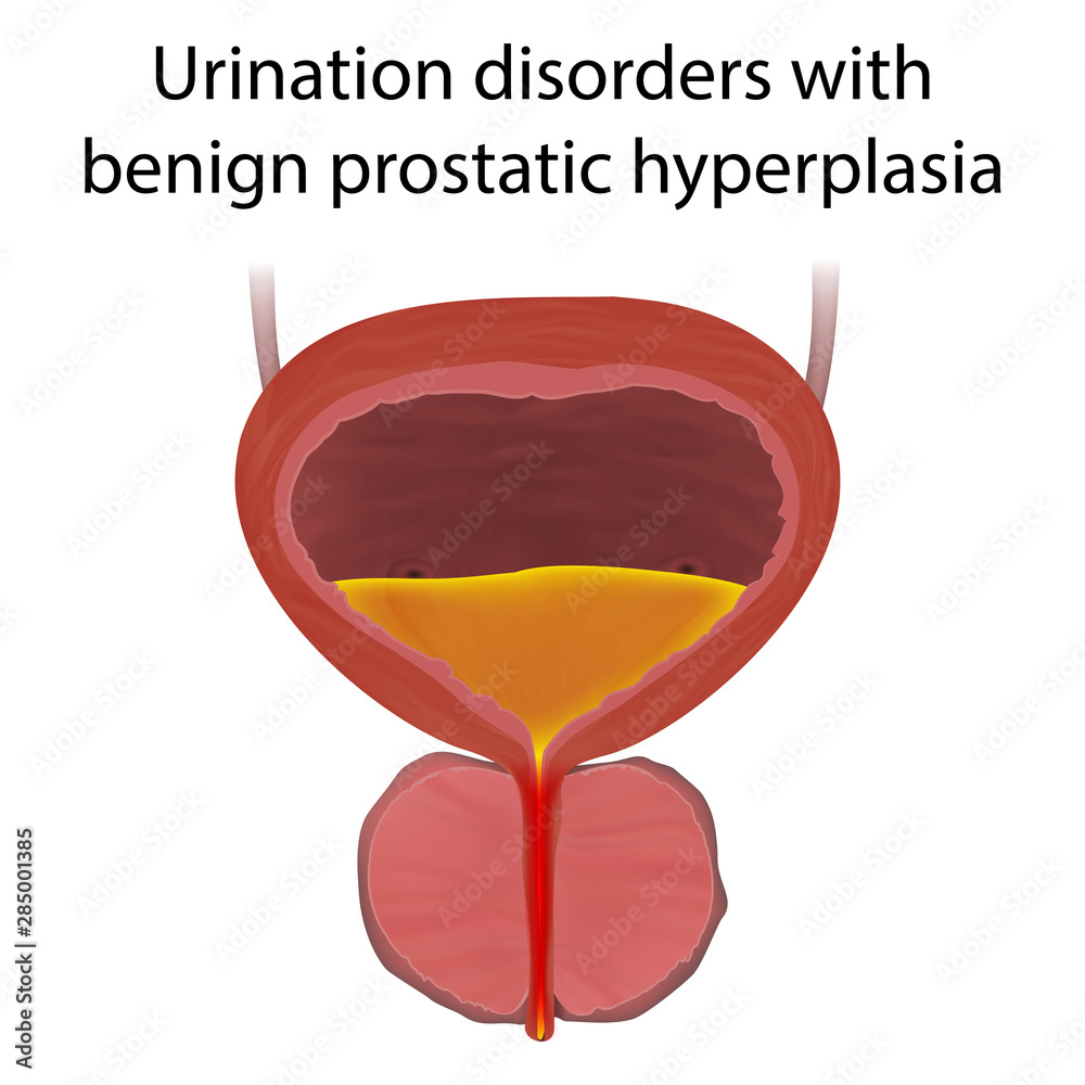 Urinary disorders with Benign prostatic hyperplasia, enlarged prostate ...