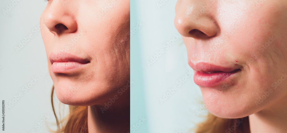 Threading Upper Lip Before And After