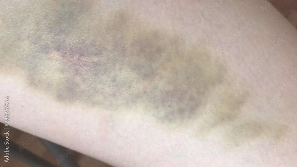Video close-up of a large bruise and hematoma on the skin of the hip of ...