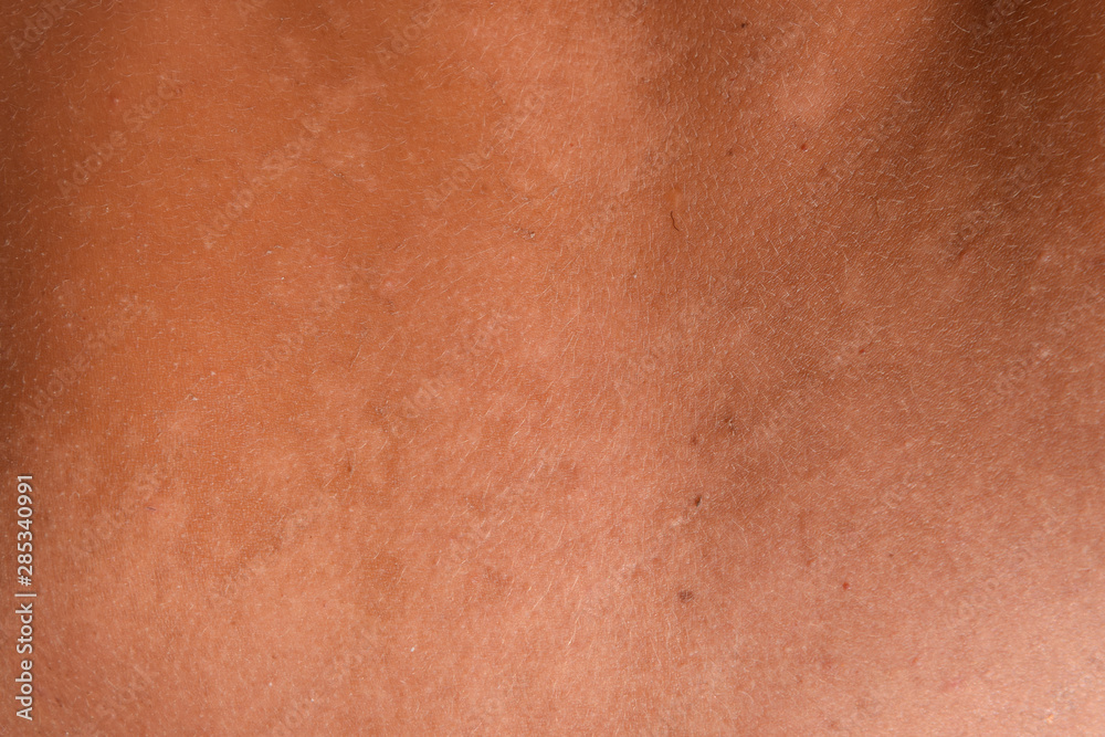 Sunburn on the skin of the back. Exfoliation, skin peels off. Dangerous ...