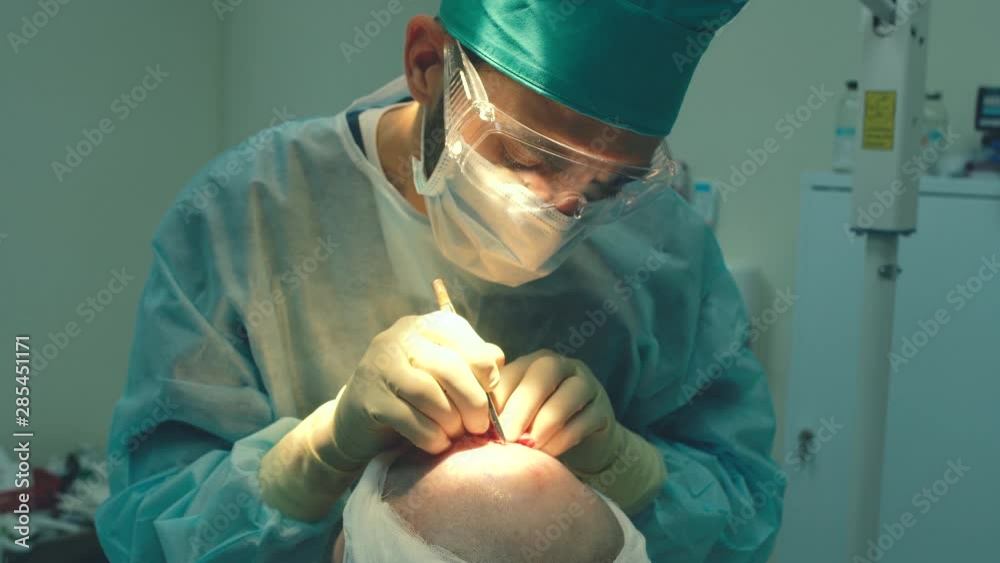 Baldness treatment. Hair transplant. Surgeons in the operating room ...
