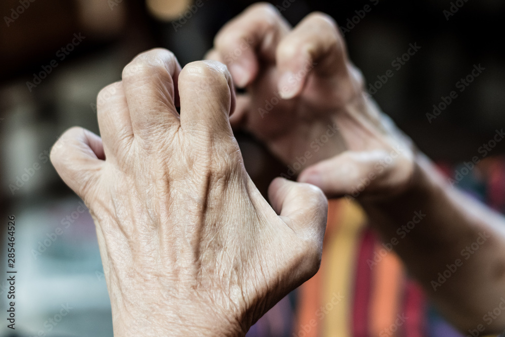 Epileptic seizure in hand with cerebrovascular disease in the older age ...