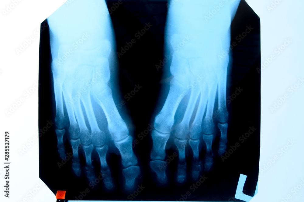 X-ray of toes. Foot on Xray. bone research Stock Photo | Adobe Stock