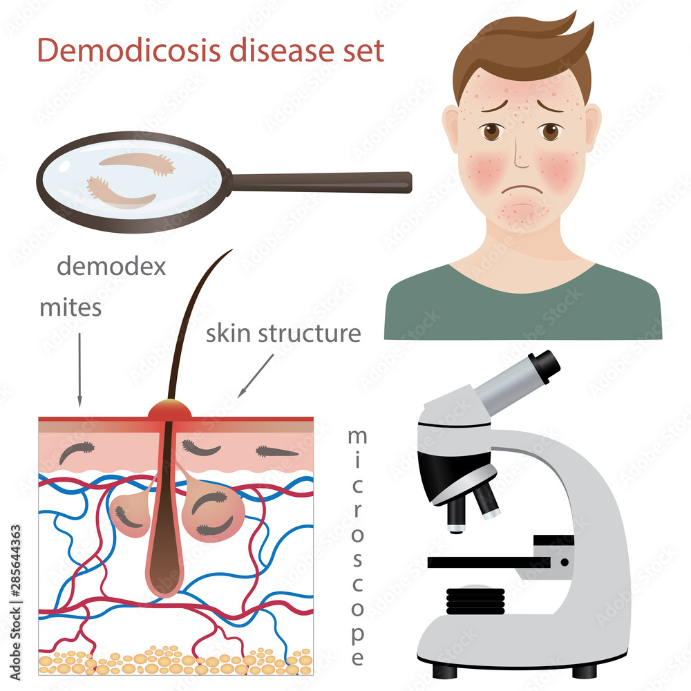 Vector set of medical illustrations with human demodicosis di Stock ...