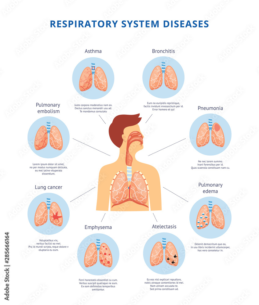 Human respiratory system diseases informative diagram vector ...