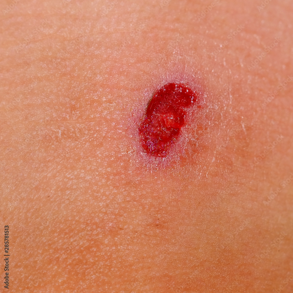 Lesion On Skin Of Human Texture Stock Photo Adobe Stock lesion-on-skin-of-human-texture-stock-photo-adobe-stock