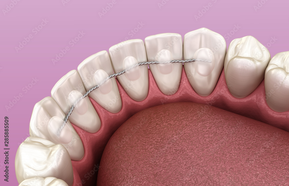 Retainers dental installed after braces treatment, Medically accurate ...