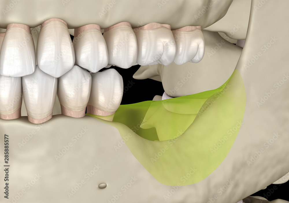 Mandibular Jaw, bone recession after losing molars teeth. Medically ...