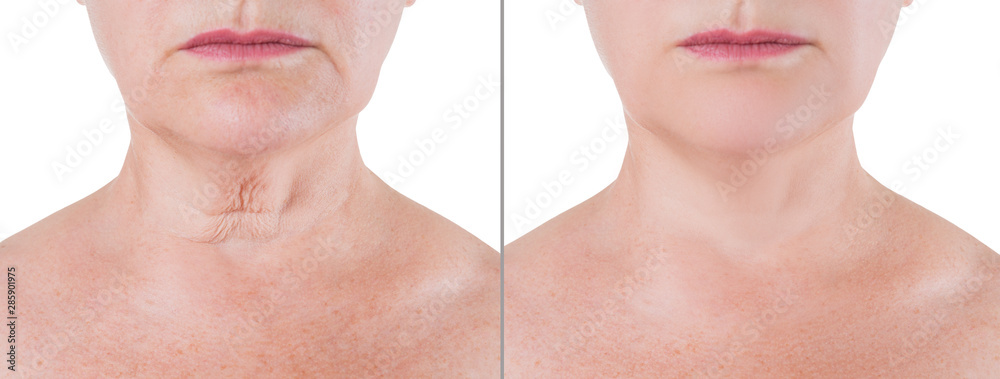 Skin rejuvenation on the neck, before after anti aging concept, wrinkle ...